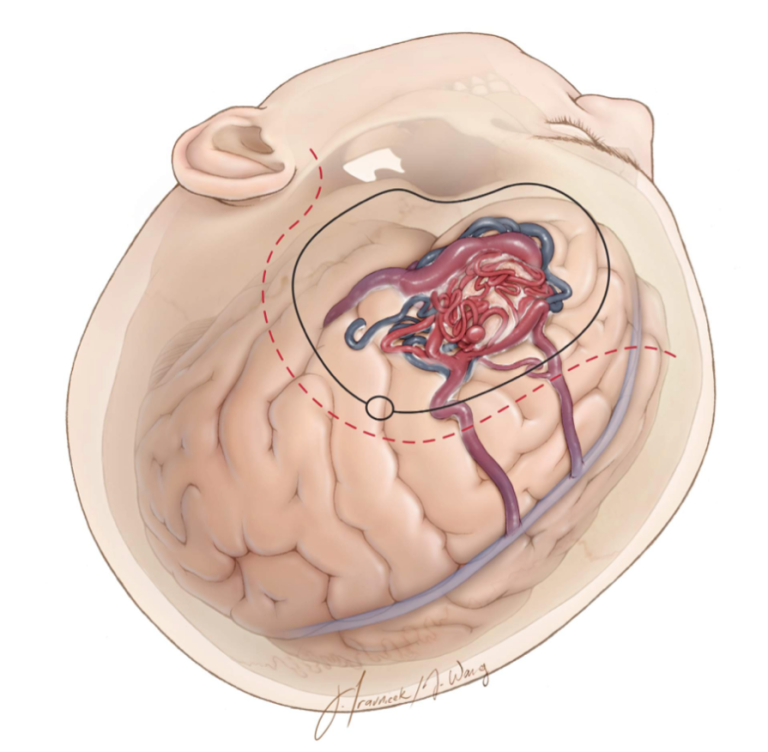 Malformaciones arterio-venosas cerebrales - SENEBA Neurocirugía Una ...